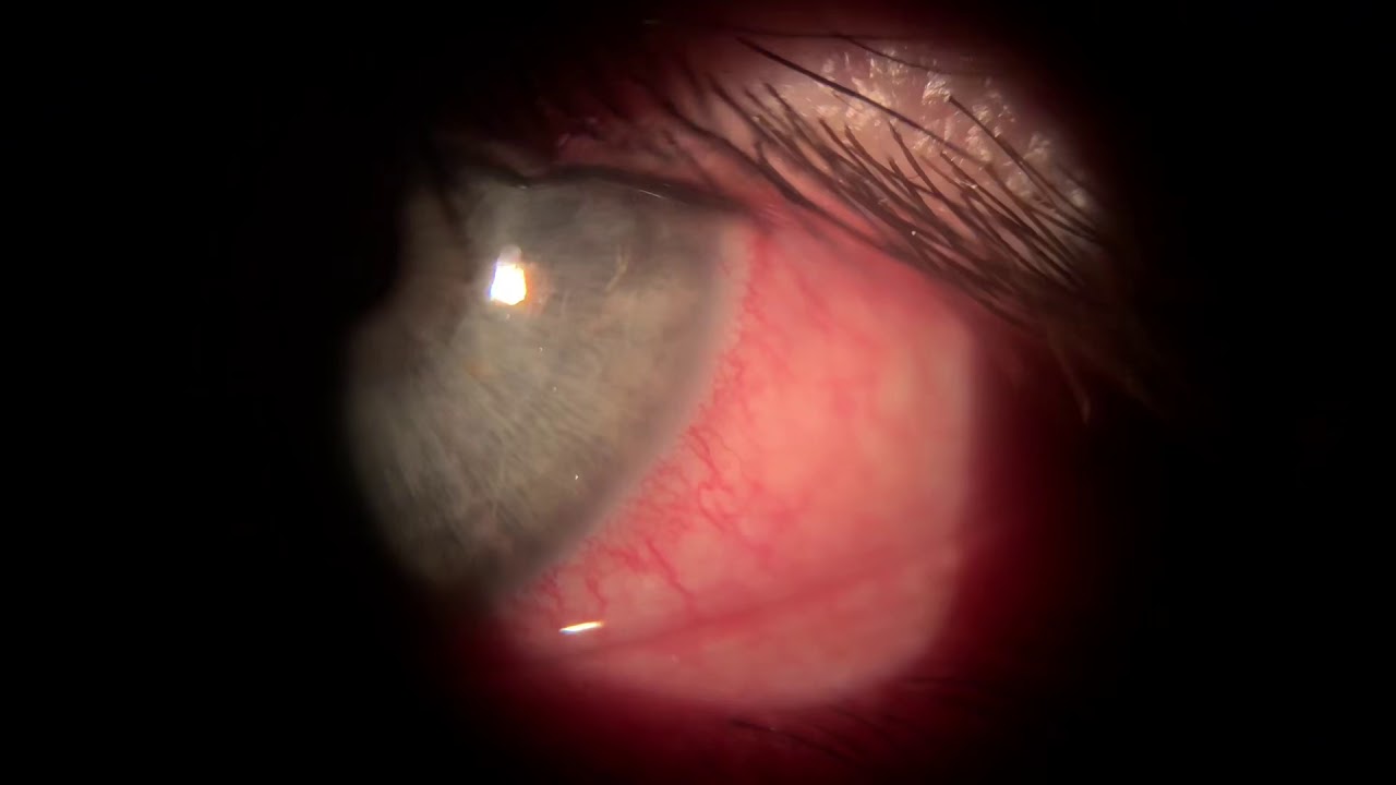 Hiperemia y neovascularización por abuso de LCH. - YouTube
