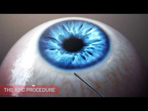 ABiC Glaucoma Eye Institute Treatment Option - YouTube
