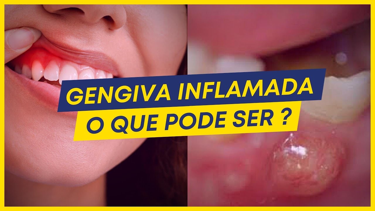 4 COISAS que fazem a SUA GENGIVA INFLAMAR | Como RESOLVER? - YouTube