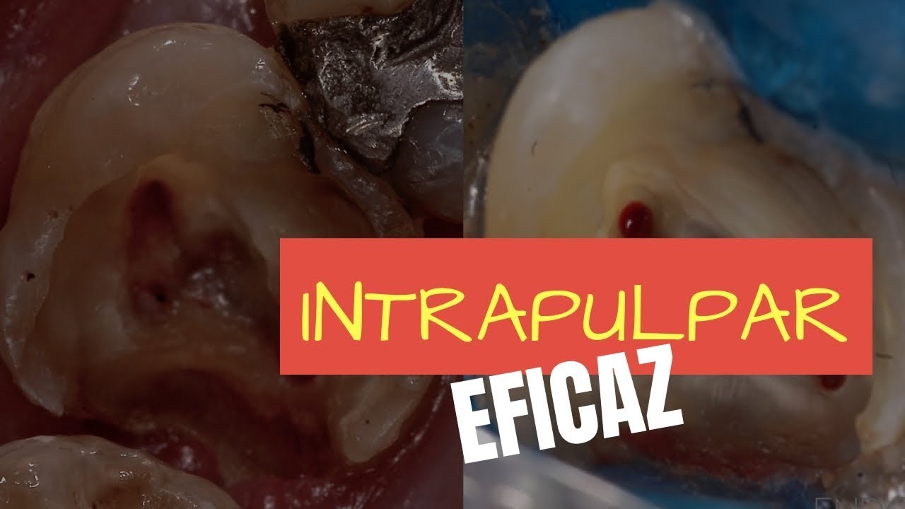OS 3 PASSOS PARA FAZER UMA INTRAPULPAR EFICAZ - QUICK TIP ENDOLOVERS ...