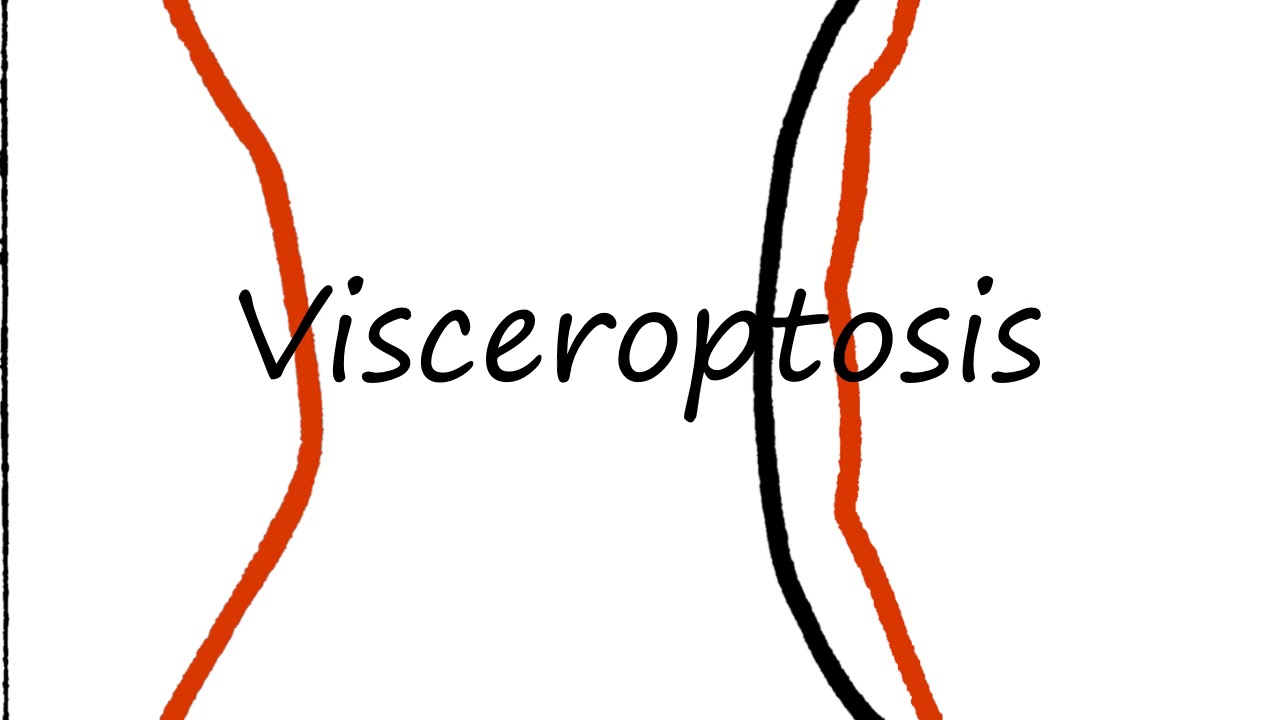 How to Pronounce Visceroptosis? - YouTube