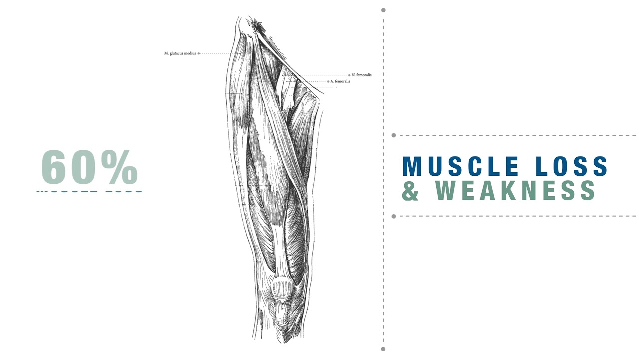 MEND Joint Replacement - YouTube