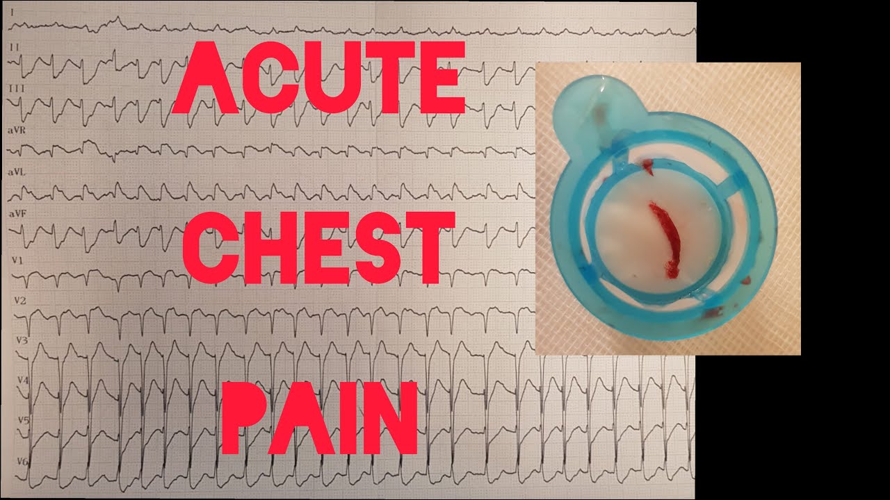 Cardiology case of a Pt. with acute chest pain and collaps. Ongoing CPR ...
