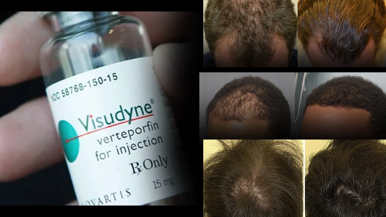 An Introduction Verteporfin and Hair Transplants - YouTube