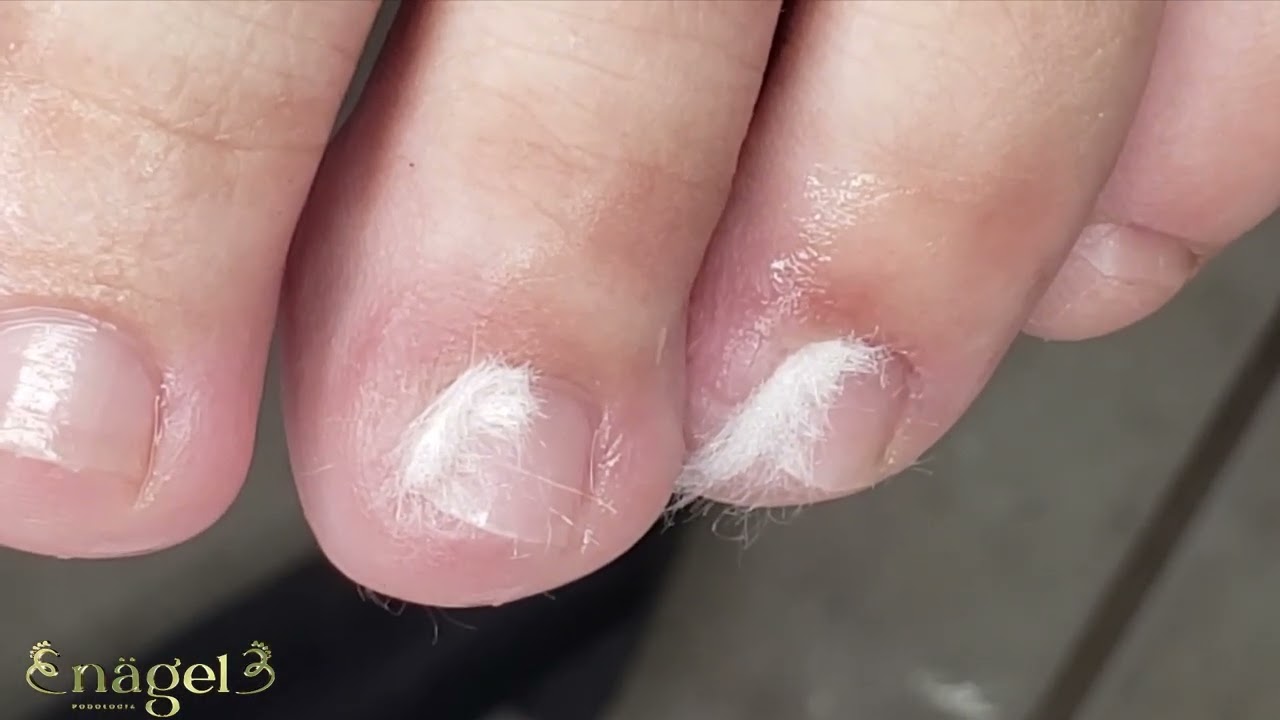 DEDINHOS ENCRAVADOS #nails #ingrowntoenail - YouTube