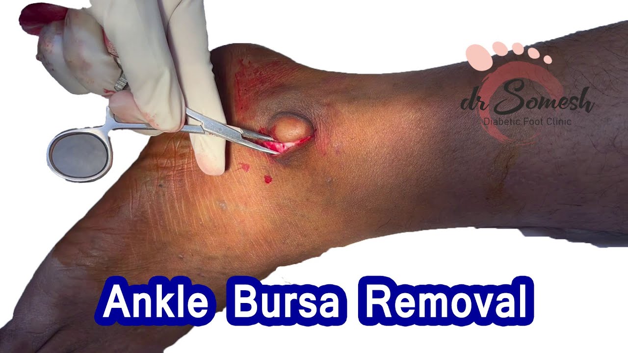 #bursa ankle removal - YouTube