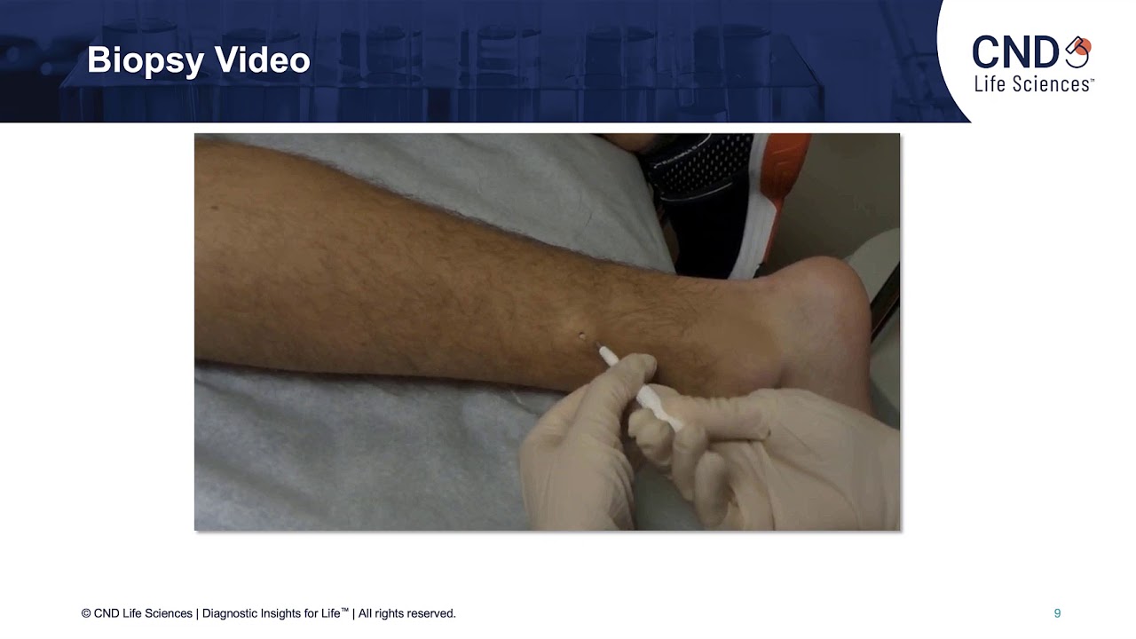 Biopsy Procedure - YouTube