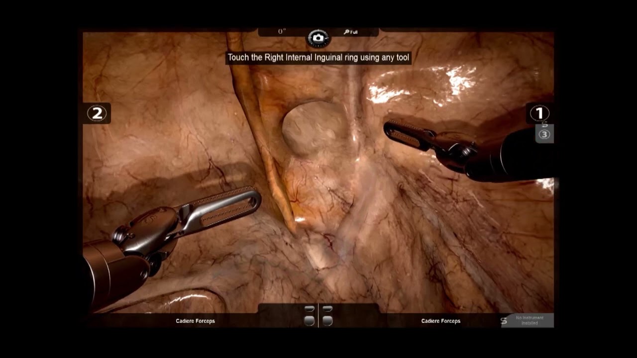 RobotiX Mentor - Robotic Inguinal Hernia Incision and Dissection - YouTube