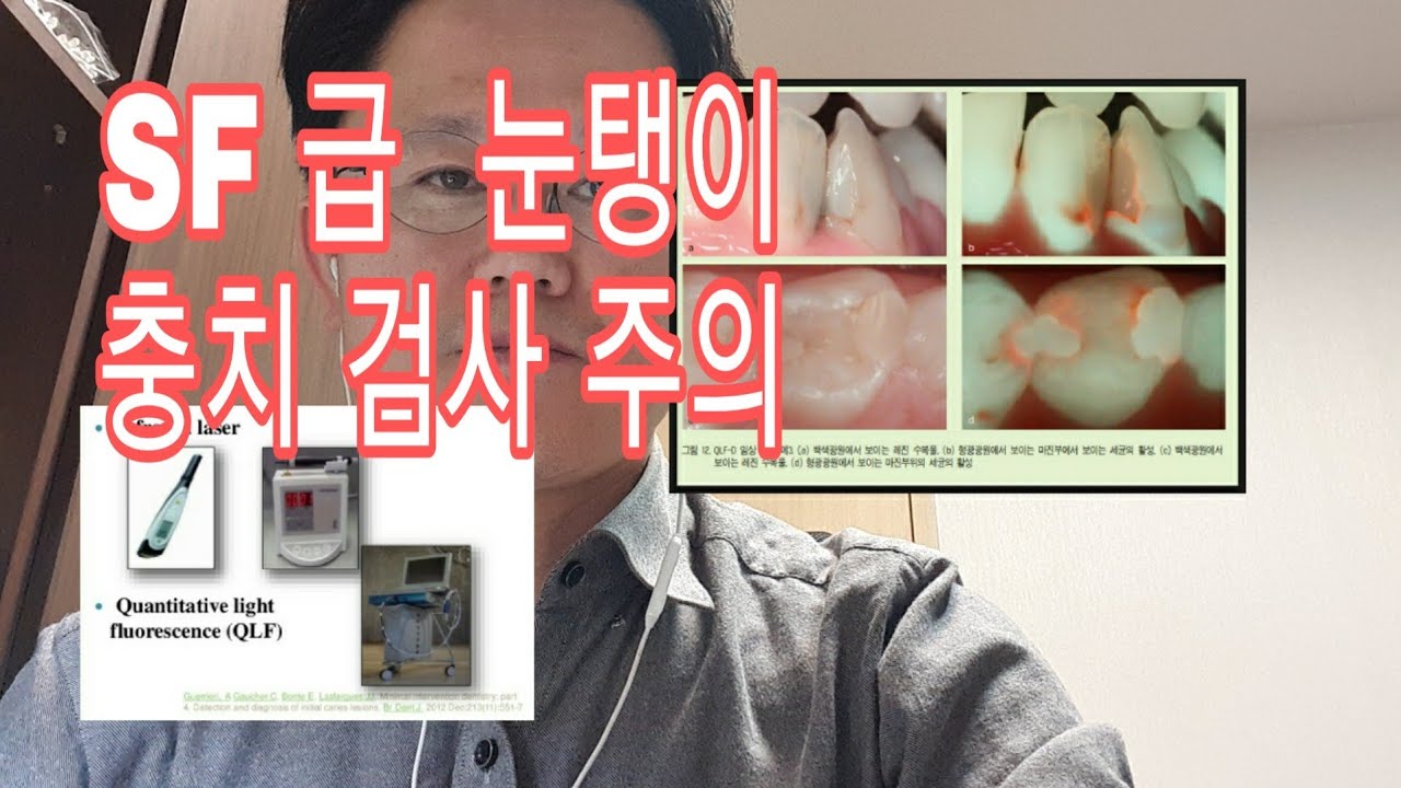 [눈탱이 최신 SF 기술 ] 충치 잘 찾는 QLF 검사 주의하세요 - YouTube