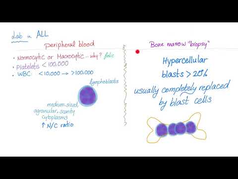 Acute Lymphoblastic Leukemia ALL Down Syndrome tDt positive - YouTube
