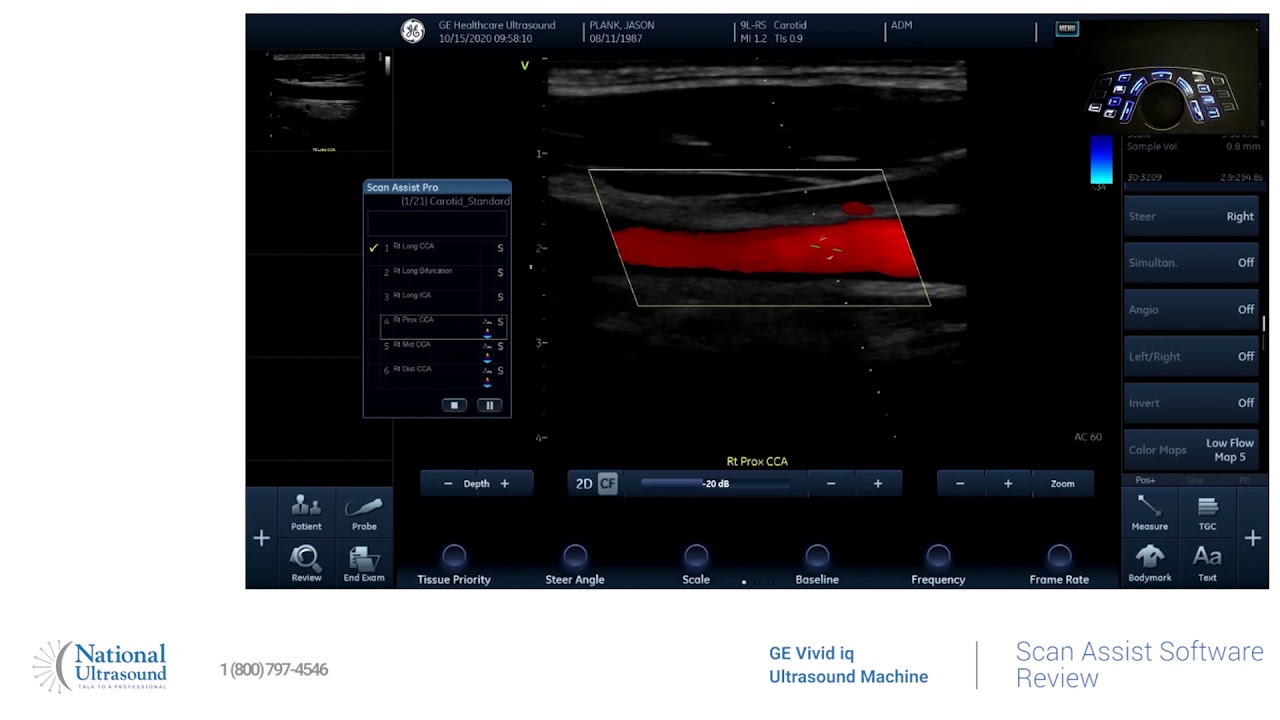 GE Vivid IQ Scan Assist Software Training Video - YouTube