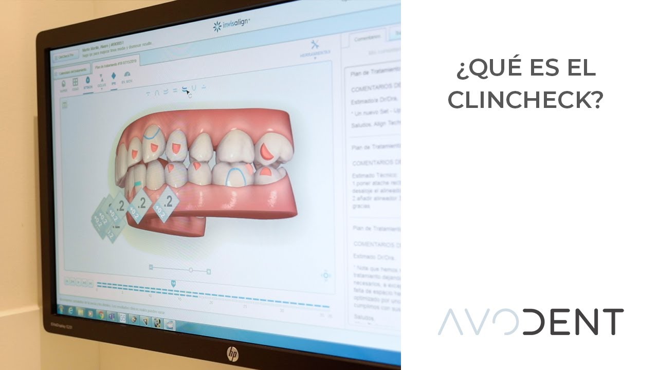 Clincheck de Invisalign: ¿qué es y qué ventajas tiene? | Clínica dental ...