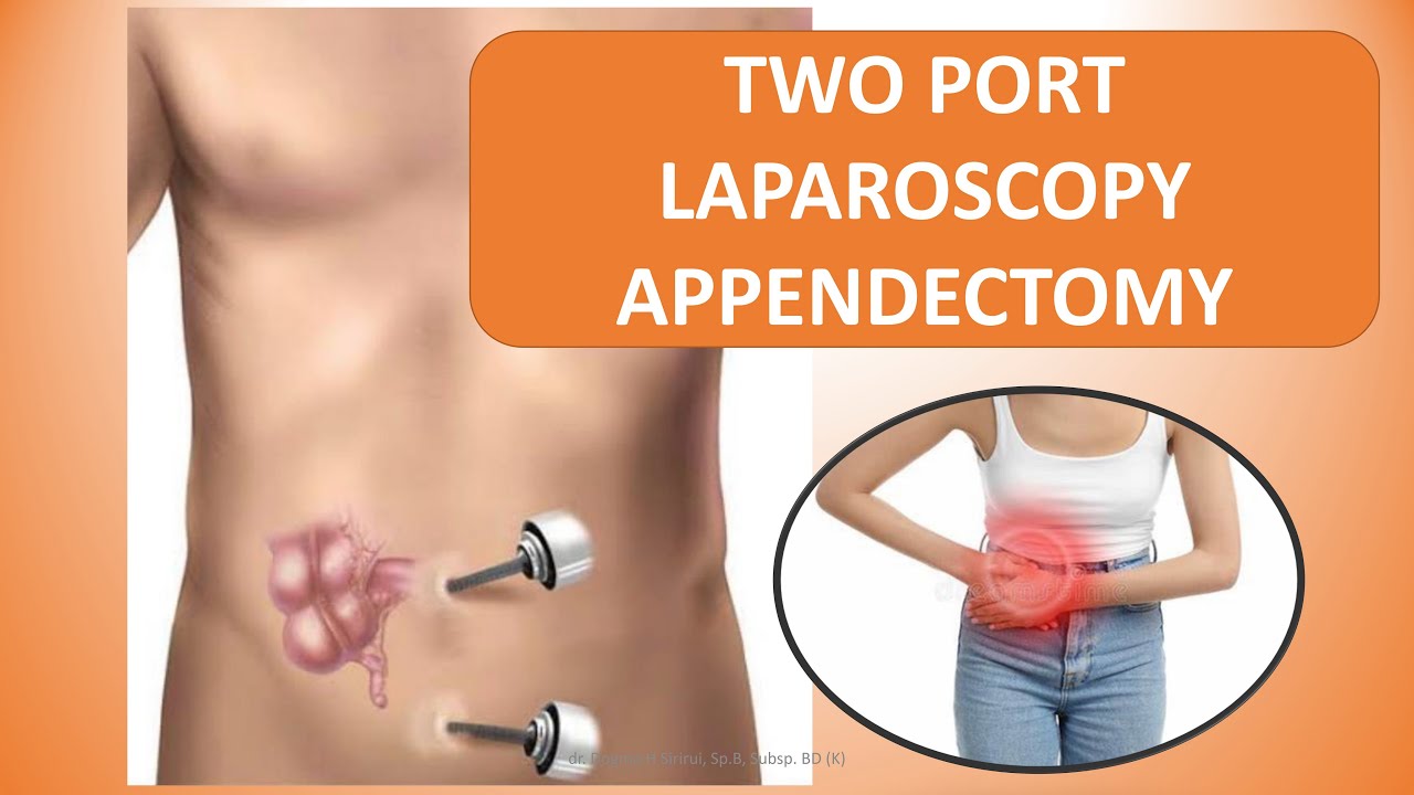 TWO PORT LAPAROSCOPY APPENDECTOMY / LAPAROSCOPY USUS BUNTU DENGAN DUA SAYATAN KECIL - YouTube