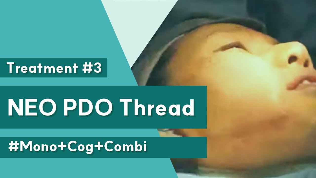 NeoGenesis Thread Series (PDO) - Mono, Cog, Combi Type Facial Procedure ...