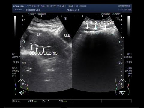 Ultrasound Video showing a rare case of Gossypiboma and “retained ...