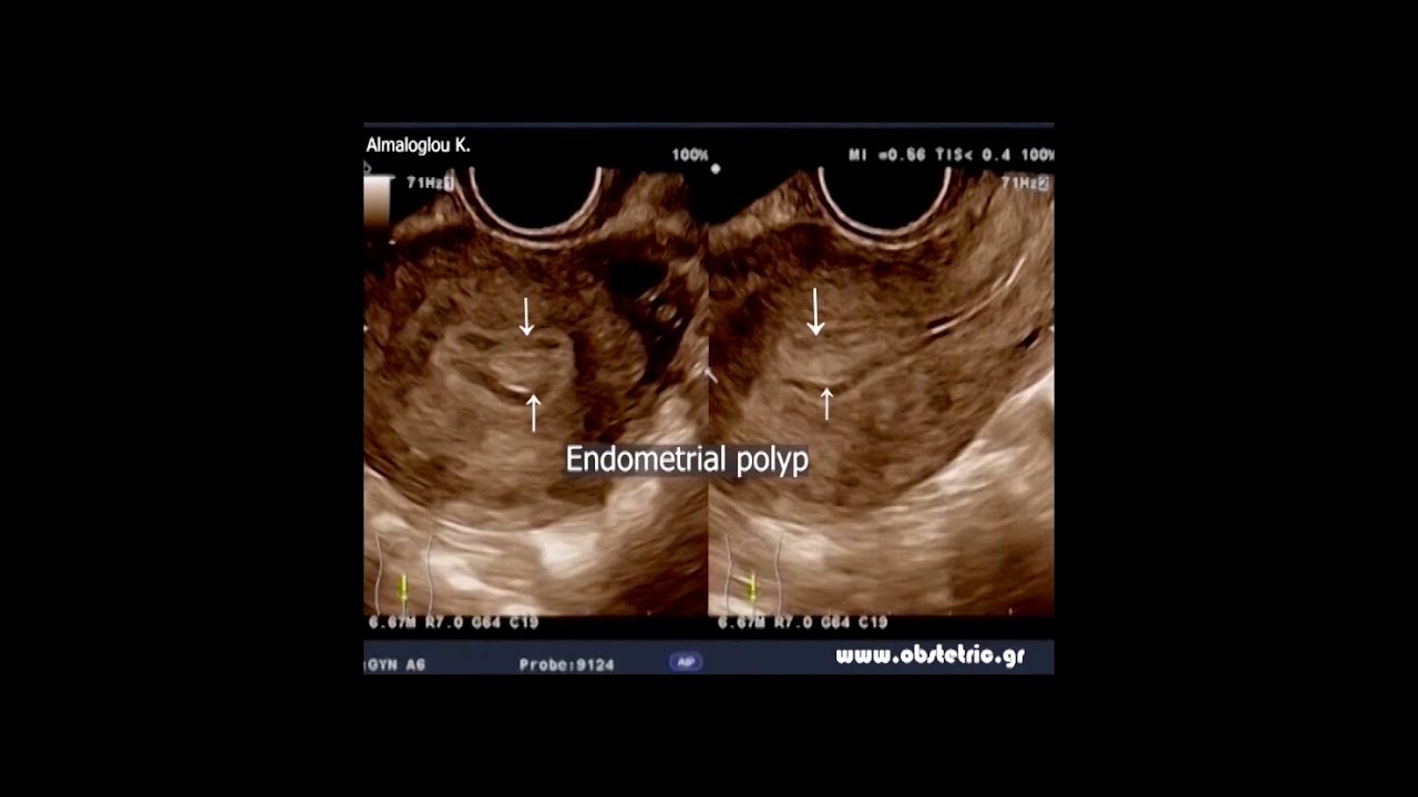 Endometrial Polyp Ultrasound Πολύποδας ενδομητρίου Youtube