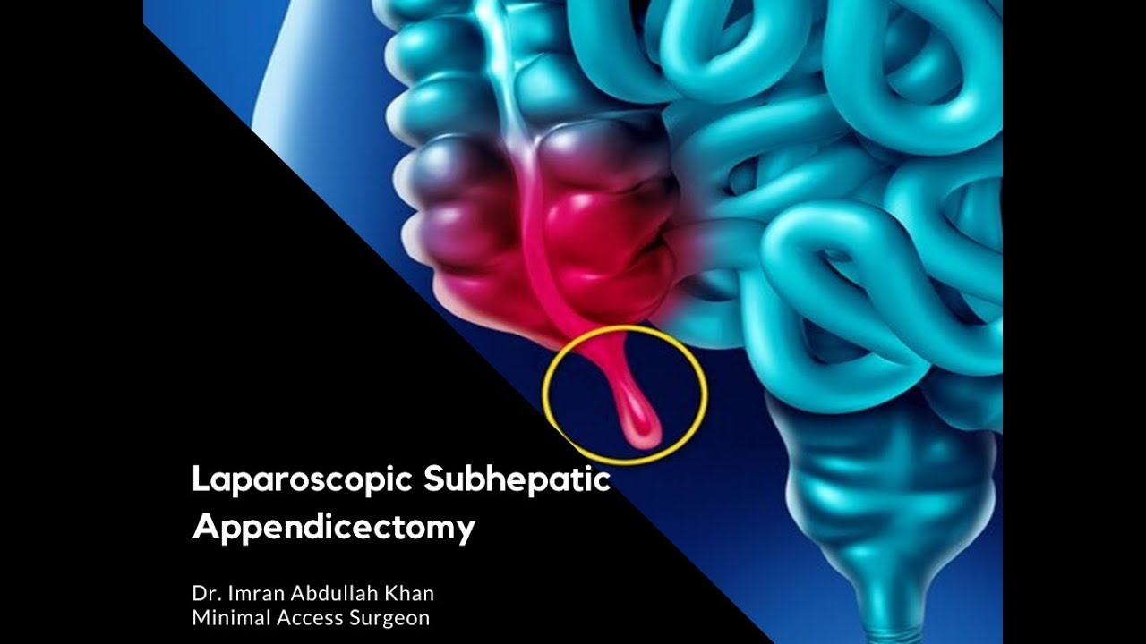 Laparoscopic Appendicectomy For Subhepatic Retroperitoneal Appendix ...