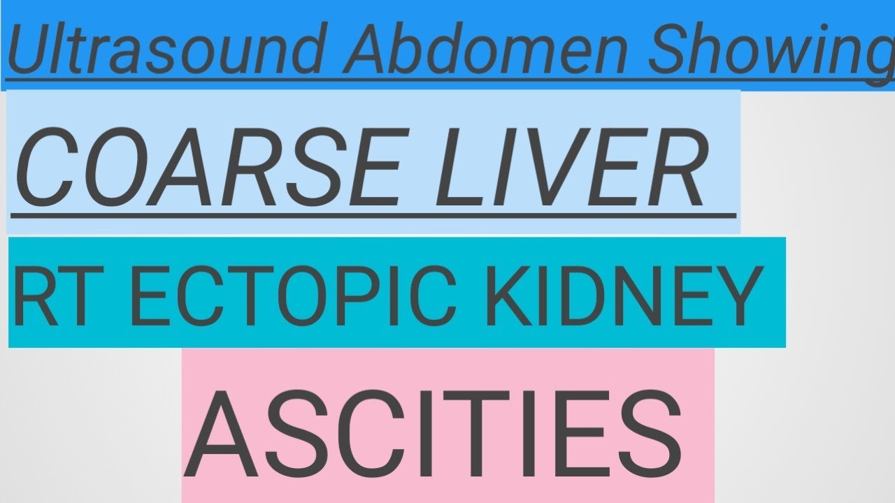 Ultrasound Abdomen!Coarse liver ultrasound! Ultrasound showing ectopic ...