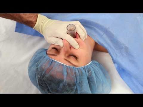 NuMask in Anesthesiology, IntraOral Mask (IOM®) / Oropharyngeal Airway (OPA) Training Video