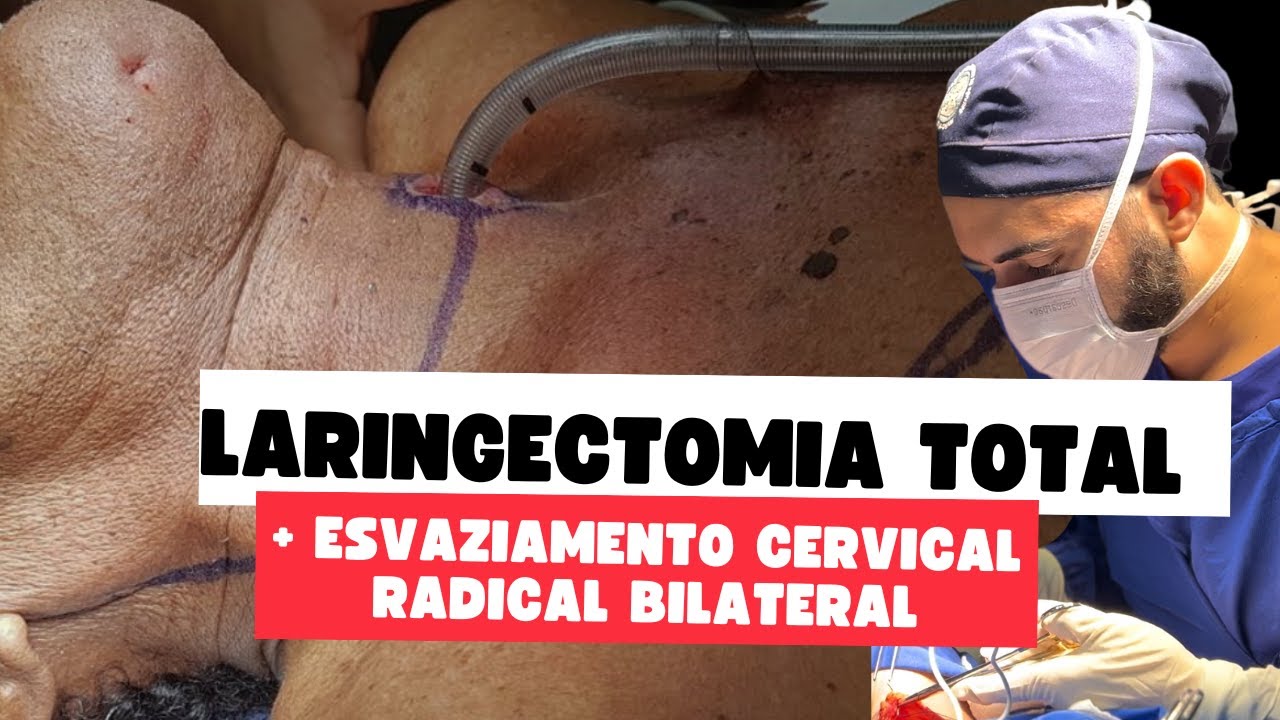 Comentários sobre câncer avançado de laringe - Laringectomia total com ...