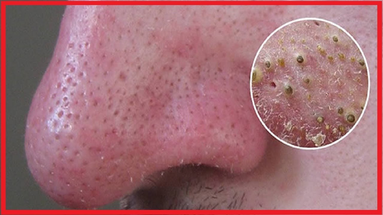 Cele mai eficiente 5 remedii pentru eliminarea punctelor negre în cel ...