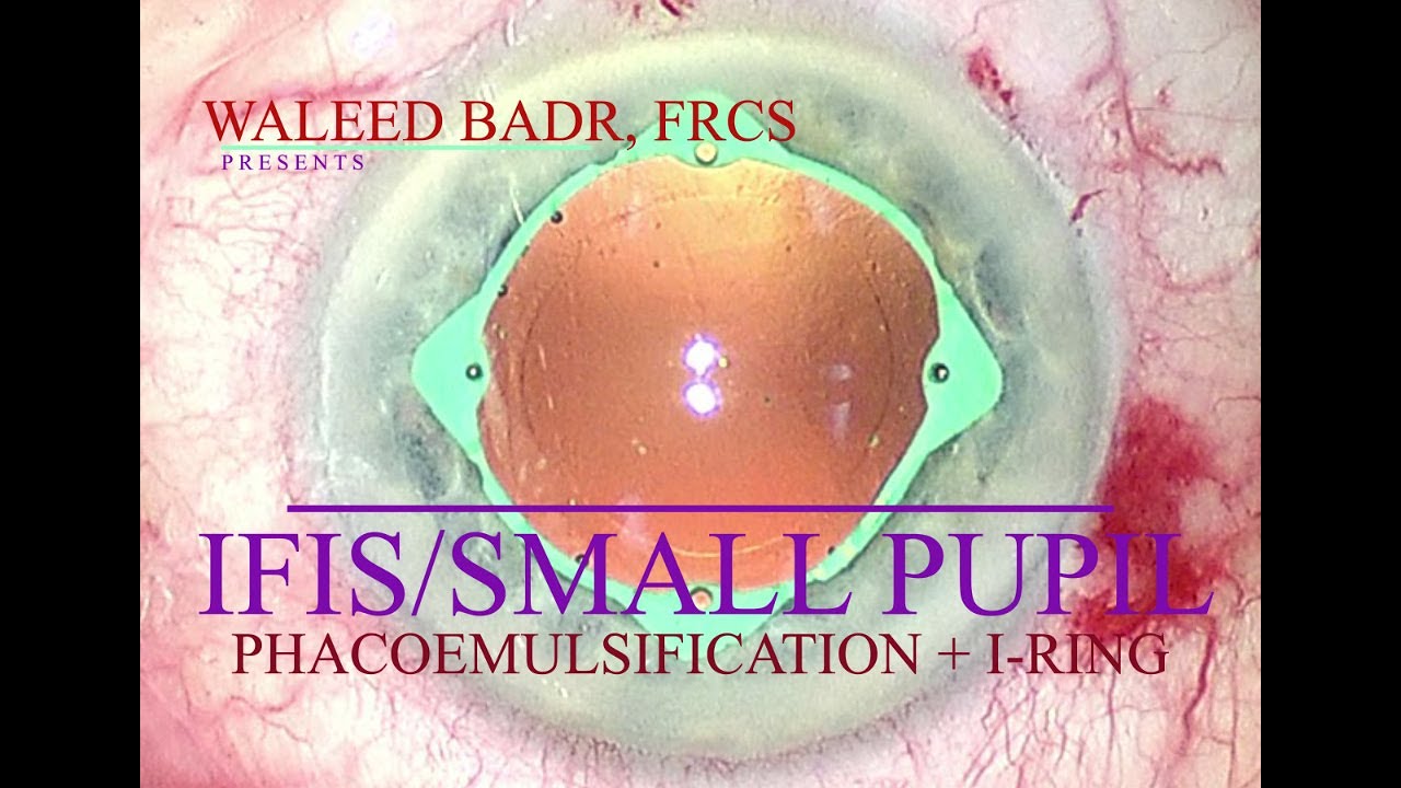 Phacoemulsification using I-Ring pupil expander for IFIS/small pupil ...