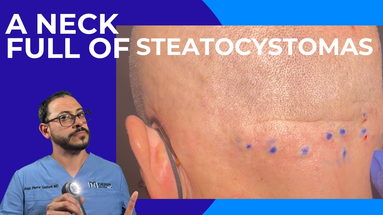 Neck full of steatocystomas . Full removal Dermatologist reacts and ...