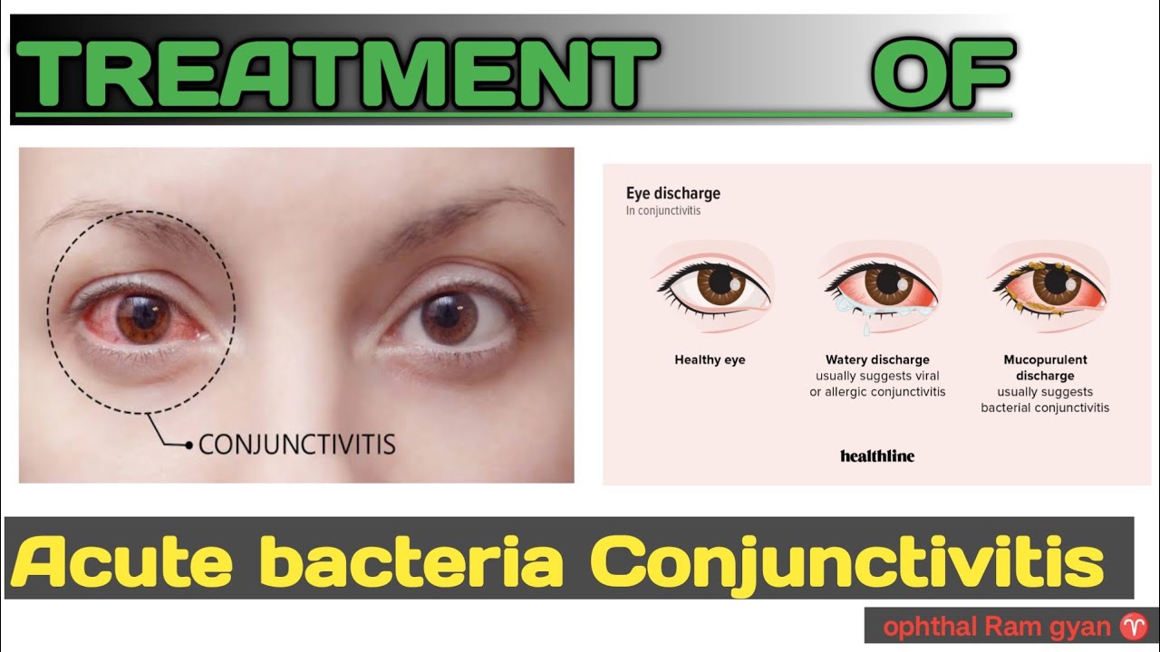 Treatment of Acute bacterial conjunctivitis || Conjunctivitis क्या होता ...