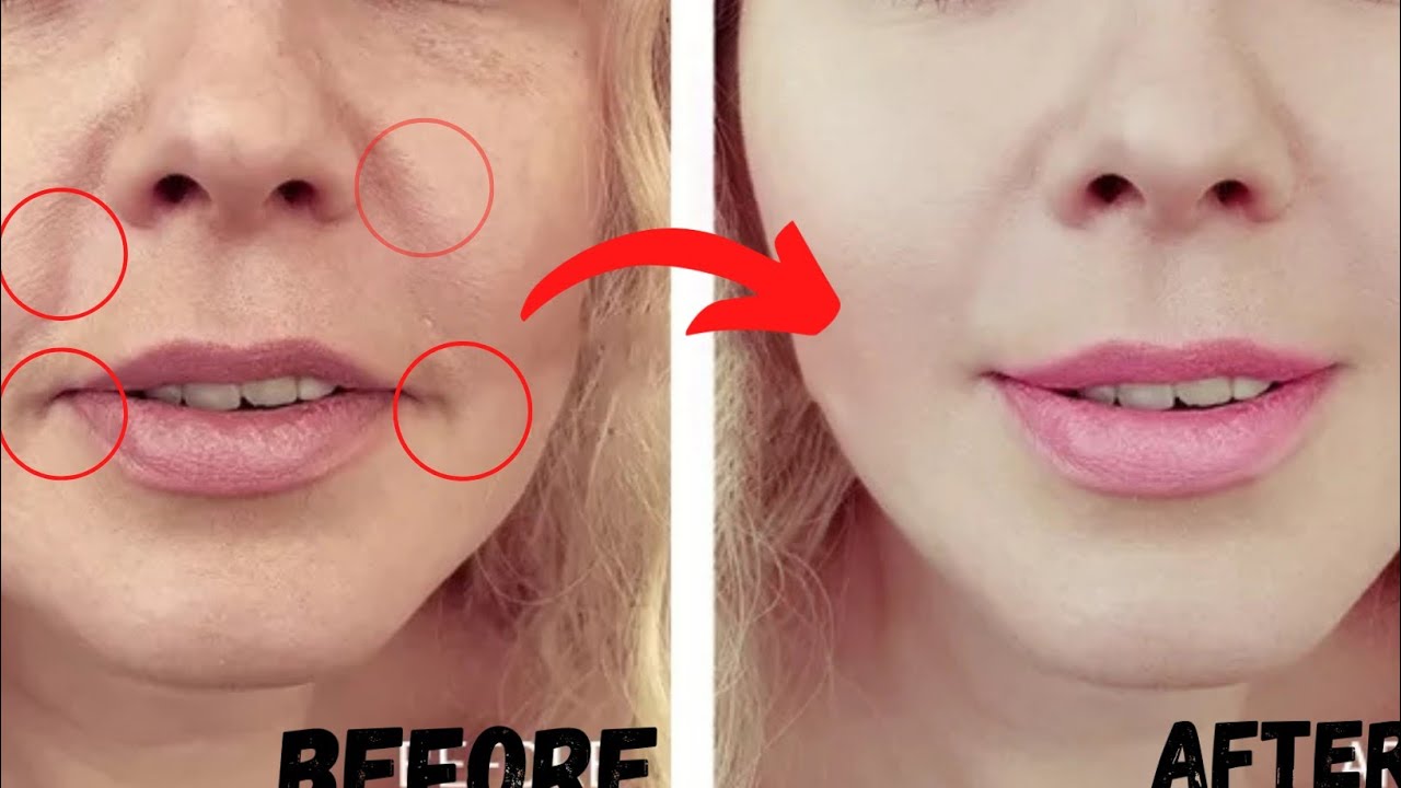 how to get rid of wrinkles ,Deep forehead wrinkles and Increase skin ...