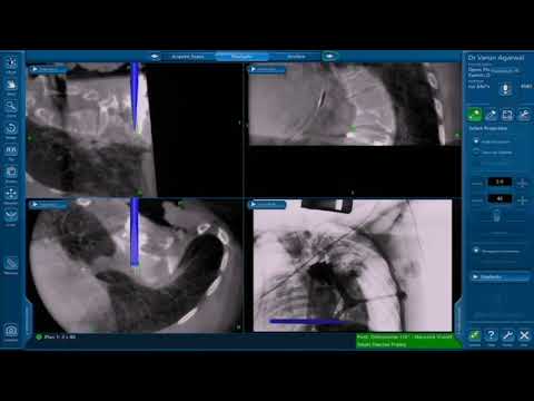 Medtronic O arm 3D Navigation guided OSTEOTOMY - YouTube
