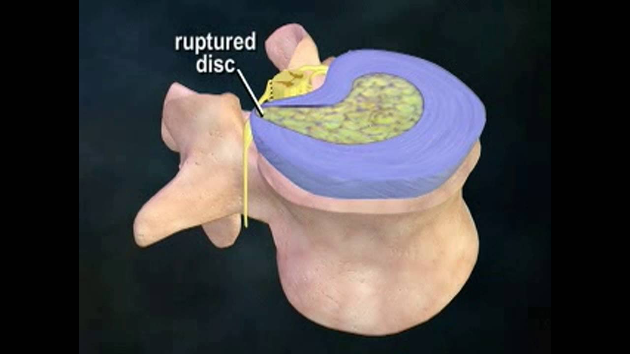 Ruptured and herniated disc animation - YouTube