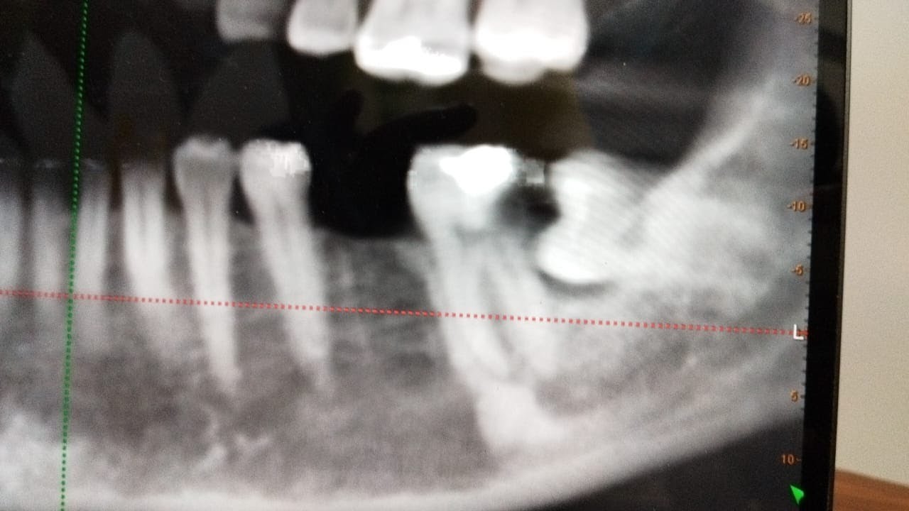 LIVE-GRossely decayed 2nd molar and impacted 3rd molar removal and ...