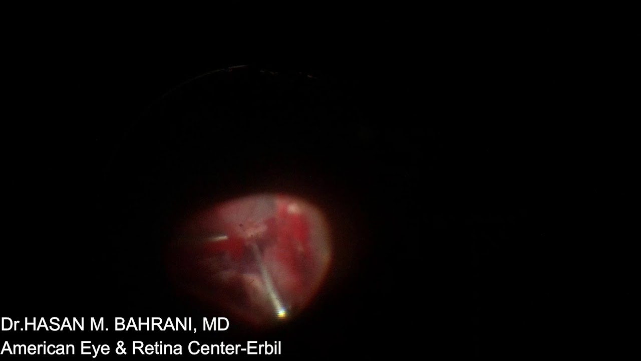 Vitrectomy Stage 4b ROP Dense VH w Retrolental Hemorrhage - YouTube