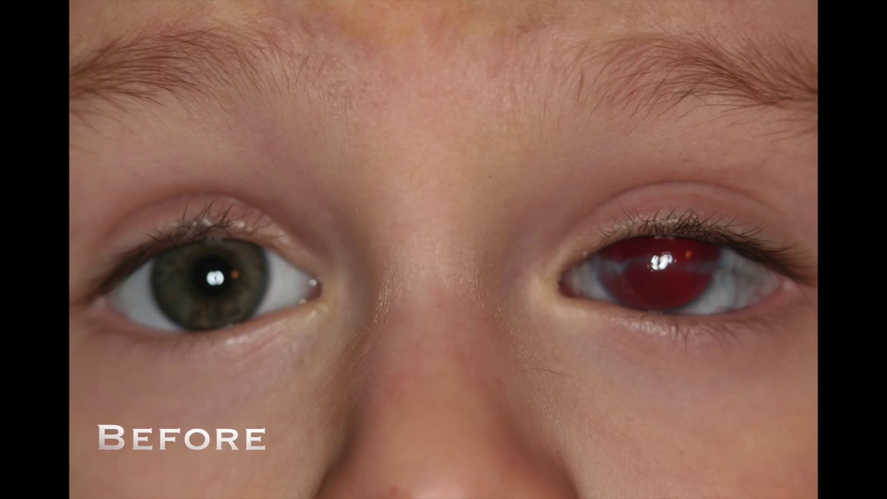 Custom Color Contacts - BEFORE and AFTER Prosthetic PHOTOS www ...