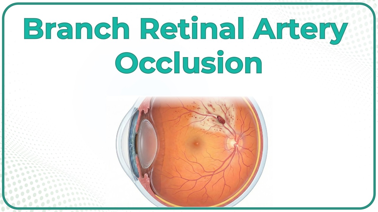 Branch Retinal Artery Occlusion (BRAO) 👁️ Internal Medicine ...