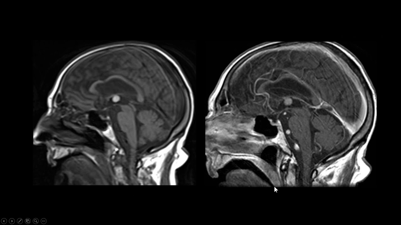 O Que é Cisto Coloide - RETOEDU