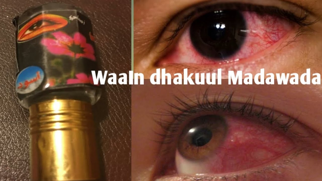 Indhaha Cuncunka, Xanuunka, iyo Biyaha Kaimanayo Waa Madaawaadkii ...