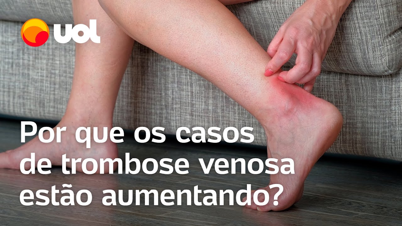 Trombose: Entenda por que os casos da doença estão aumentando; veja ...