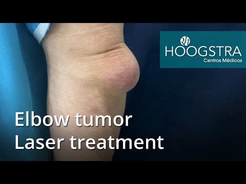 Elbow tumor - Laser treatment (20266) - YouTube