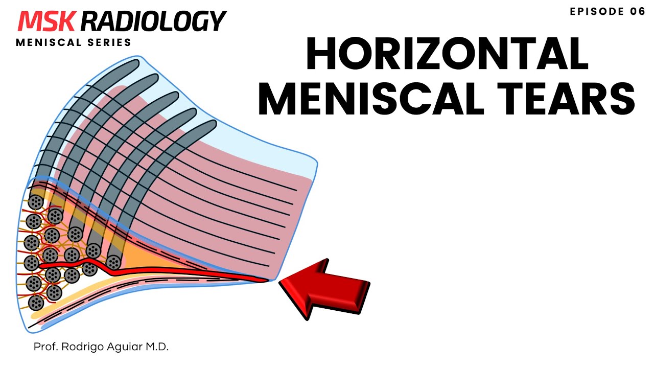 Horizontal Meniscal Tear on MRI - YouTube