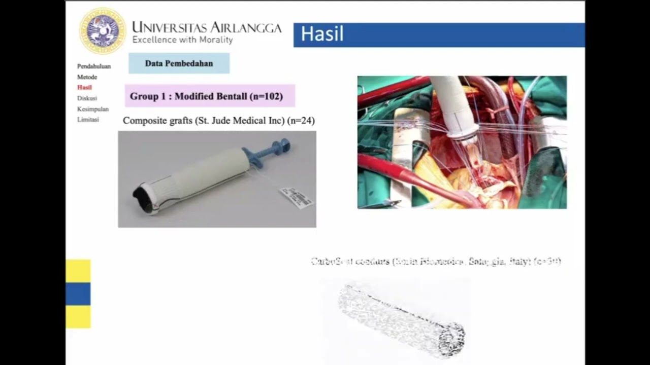 Bentall vs David Procedure - YouTube