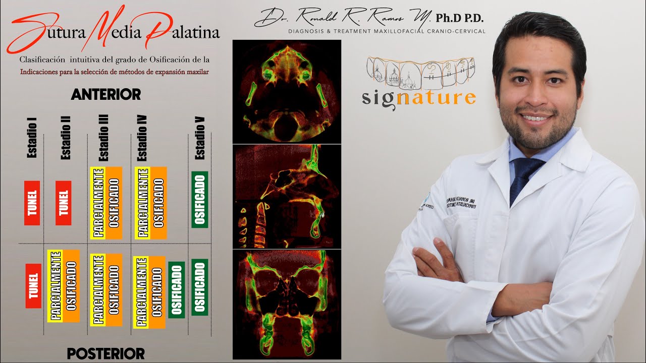 Clasificación de la OSIFICACIÓN de la SUTURA PALATINA MEDIA basado en ...