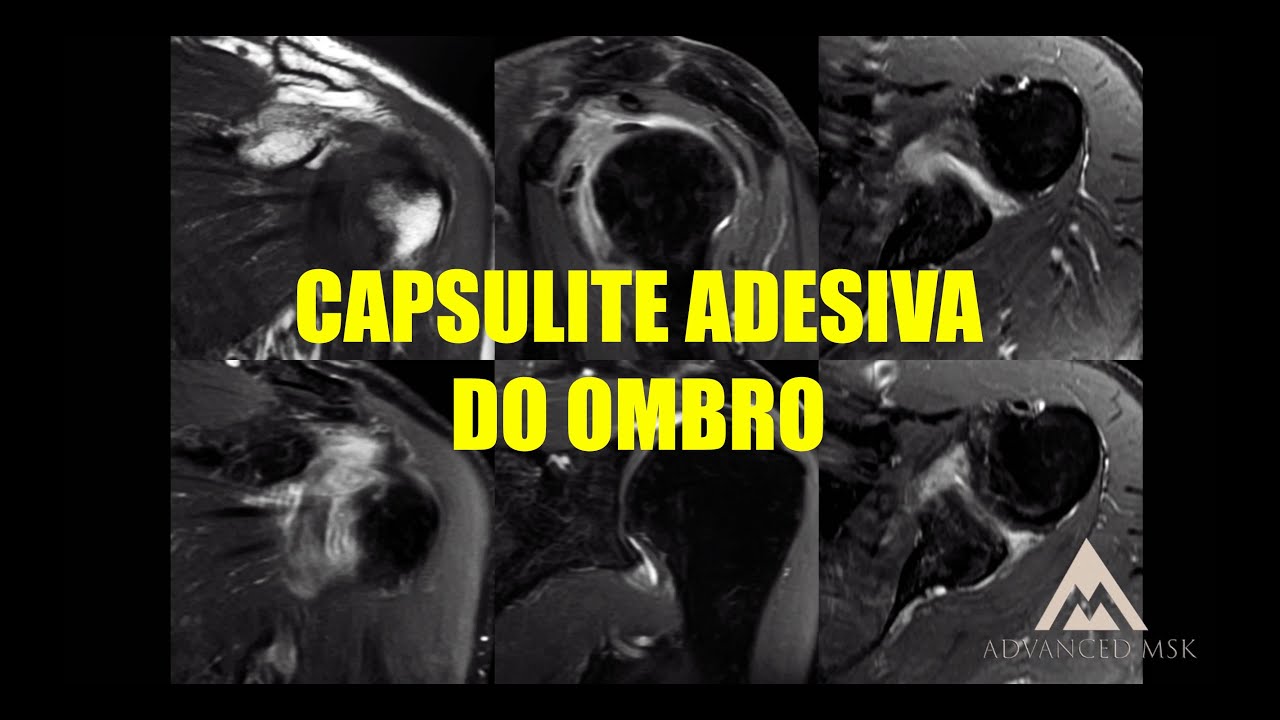 Caso #18 - Capsulite adesiva do ombro - YouTube