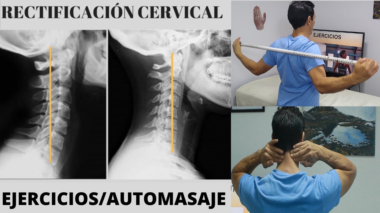 Rectificación cervical / que es ? - YouTube