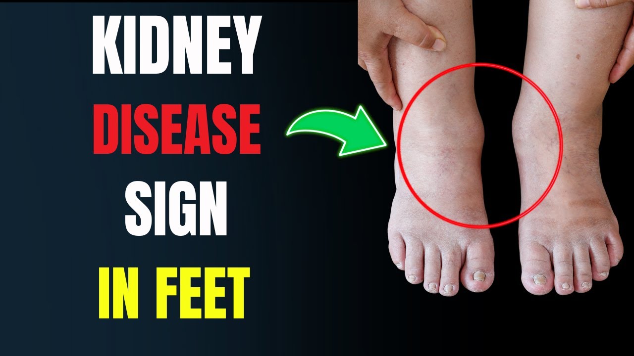 7 Silent Warning Signs of Kidney Disease Hidden in Your Feet - YouTube