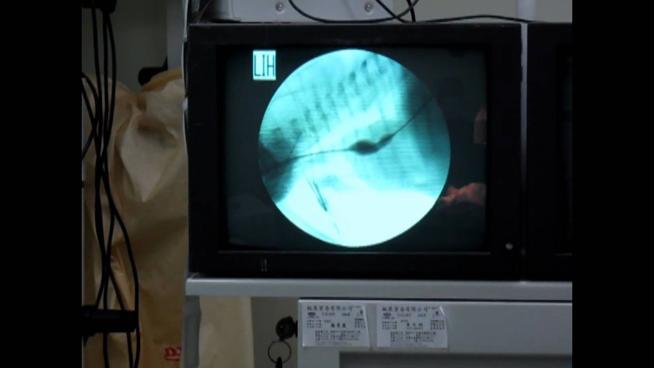 Breaking the Cor Triatriatum Dexter in a dog - YouTube