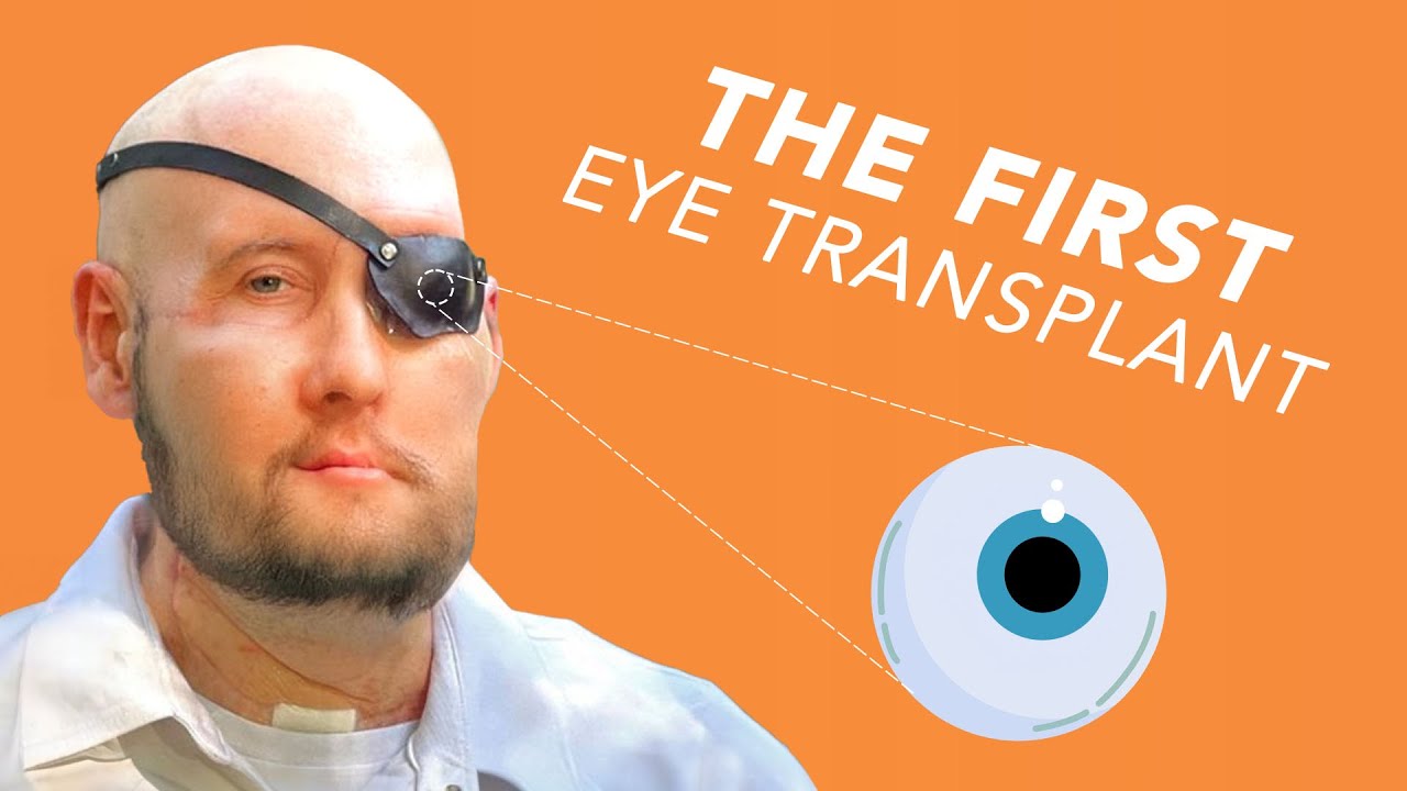 Was The First Eye Transplant SUCCESSFUL? - YouTube