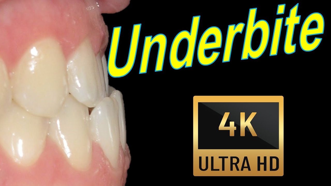 ️‍🔥 UNDERBITE in Adults for 7 MONTHS in #4k ️ - YouTube