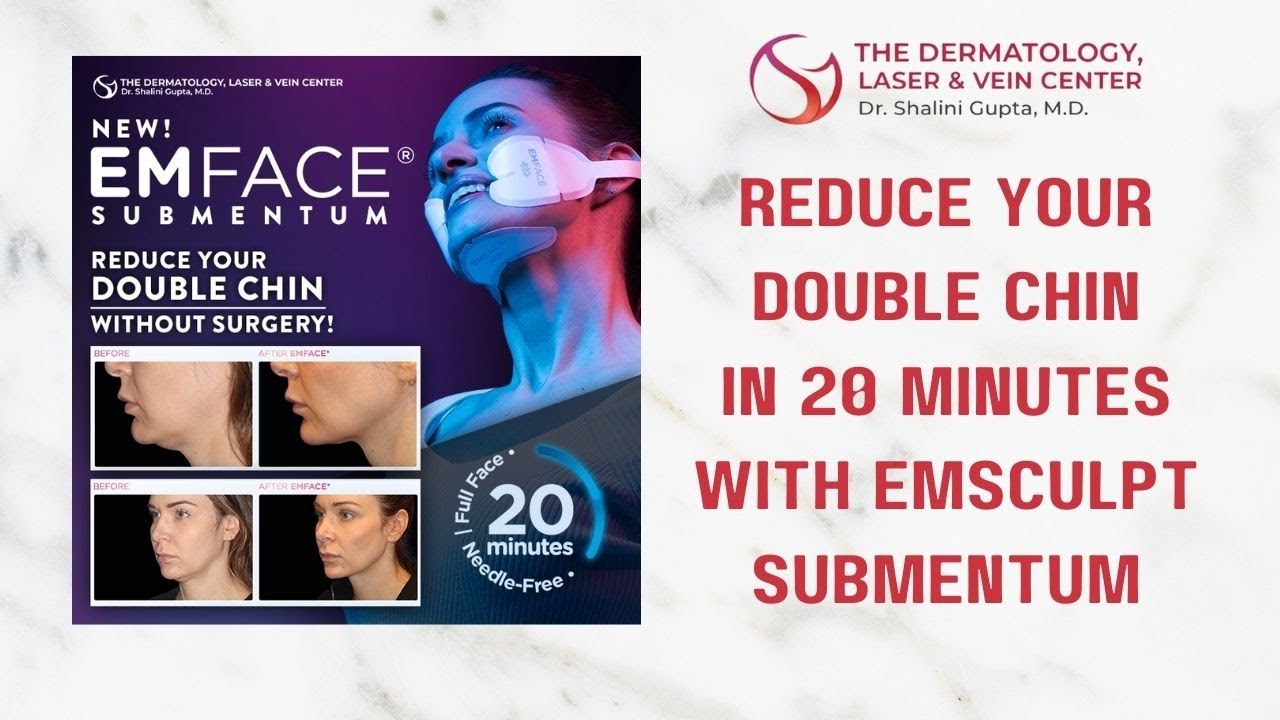 Reduce your double chin in 20 minutes with the new Emface Submentum # ...