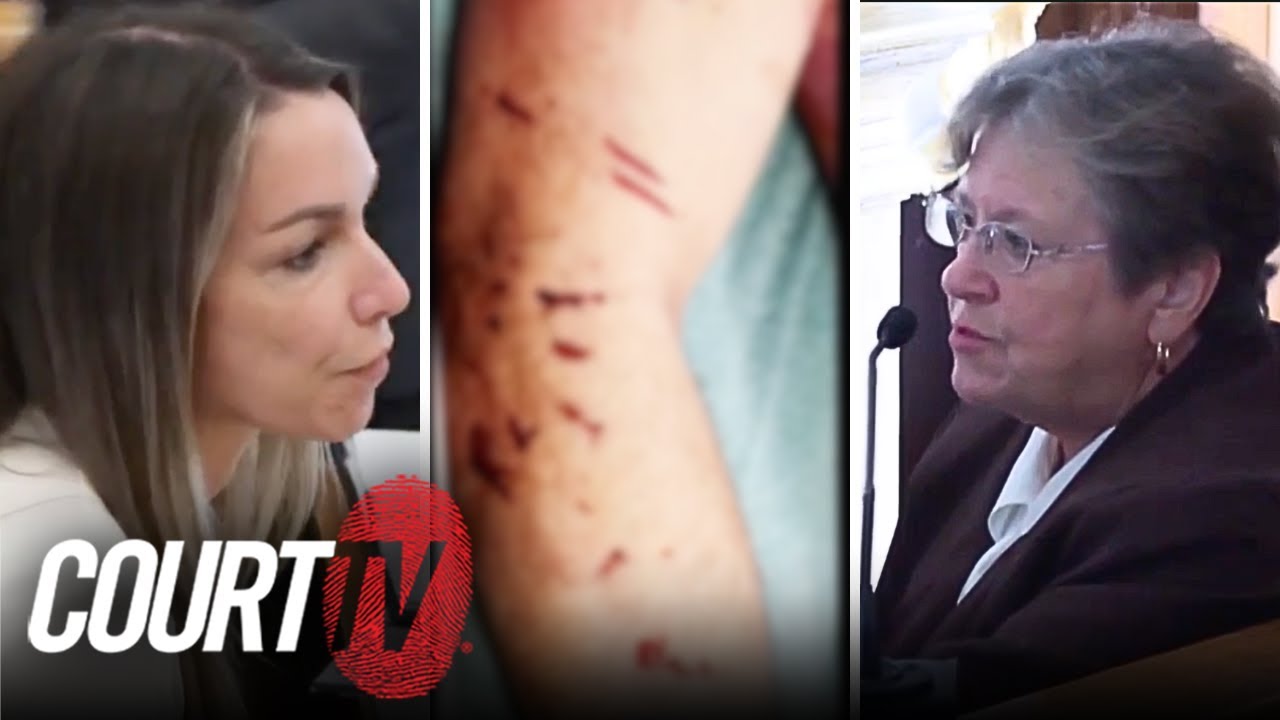 Karen Read Defense Expert: Teeth Or Claw Marks On John O'Keefe - YouTube